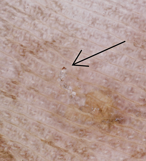 Vid klåda, tänk alltid på skabb! – Läkartidningen